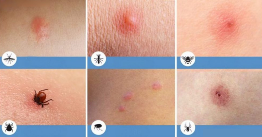 8 vabzdžių įkandimų tipai, apie kuriuos privalote žinoti - VMarkus
